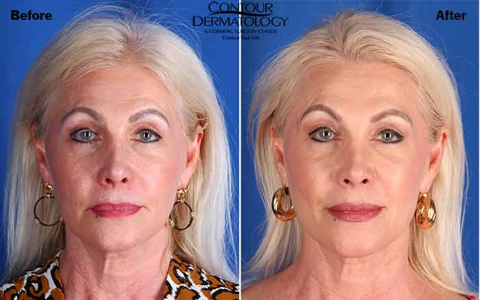 Contour Dermatology Dermal Fillers - Facial Fillers | Restylane ...