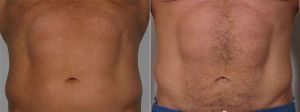 VelaShape III™ For Body Reshaping & Cellulite Reduction | Contour ...