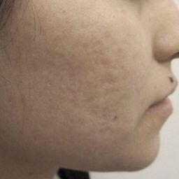 Acne and Scars | Reduce Scaring | Contour Dermatology