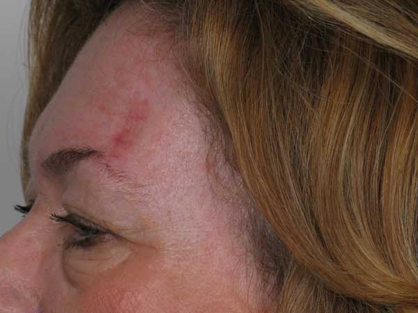 Cutera Excel V Laser - Palm Springs, Palm Desert, Rancho Mirage, La ...