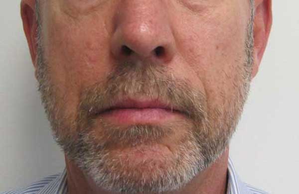 Silikon 1000 | Contour Dermatology