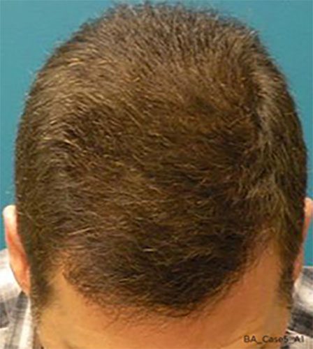 Capillus - The Easiest Way To Treat Thinning Hair | Palm Desert | Palm ...