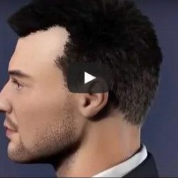 NeoGraft – State of the Art Hair Restoration and Transplant