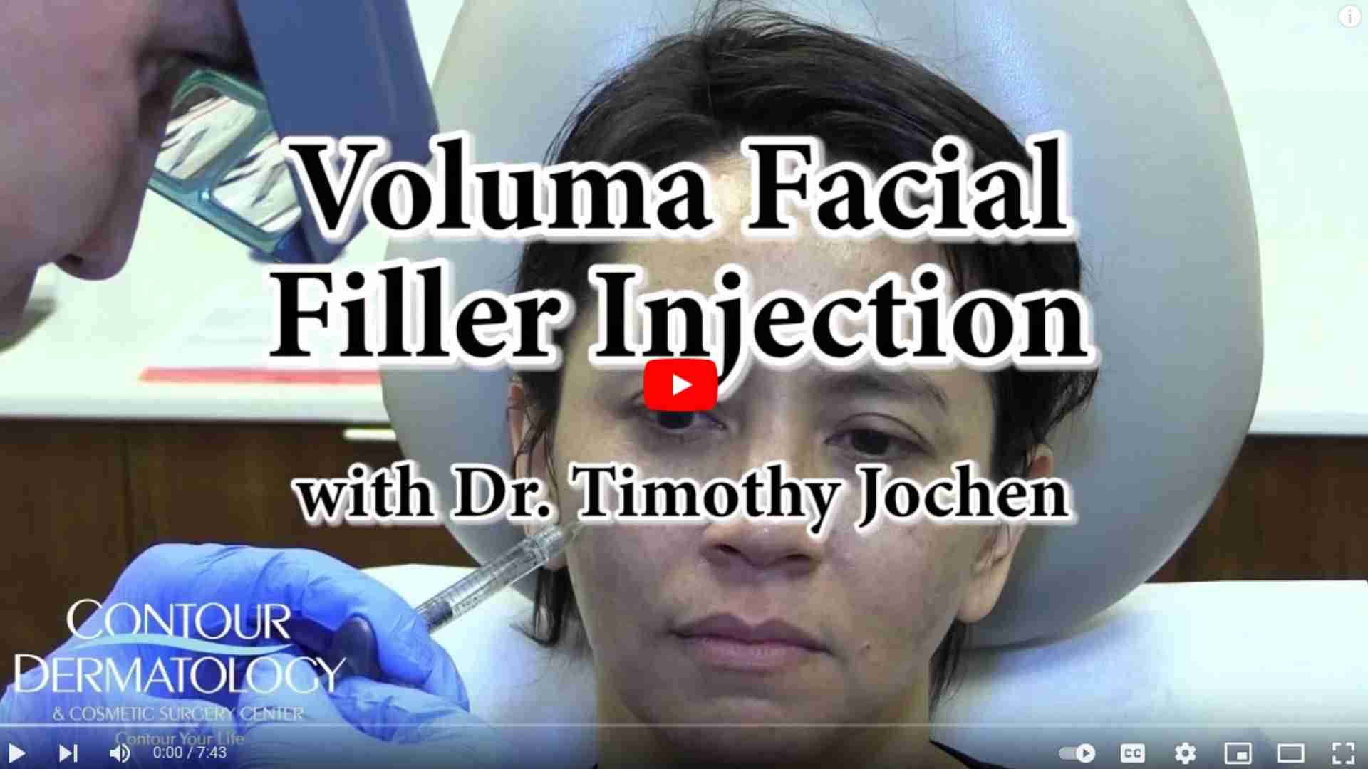 Voluma Facial Filler injection with Dr. Timothy Jochen