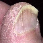 Nail Dystrophy and Disease | Contour Dermatology