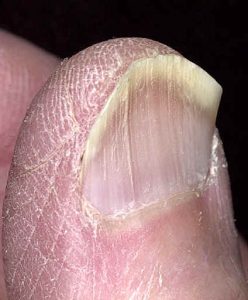 Nail Dystrophy and Disease | Contour Dermatology