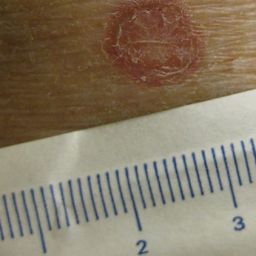 Disseminated Superficial Actinic Porokeratosis (DSAP)