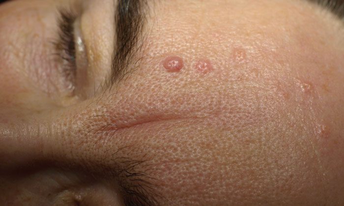 What Is Sebaceous Hyperplasia And How To Treat It 