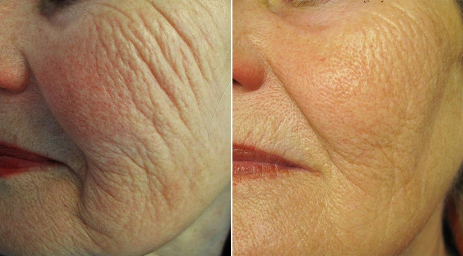 Profound – Make it Snappy! | Contour Dermatology