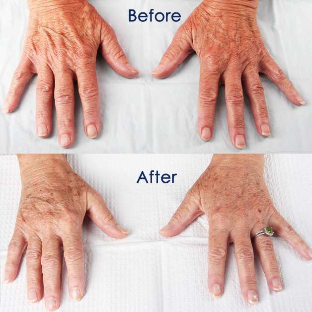 Don't Let Hands Give Your Age Away | Contour Dermatology