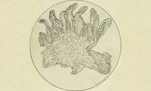Condyloma Acuminata – Genital Warts | Contour Dermatology