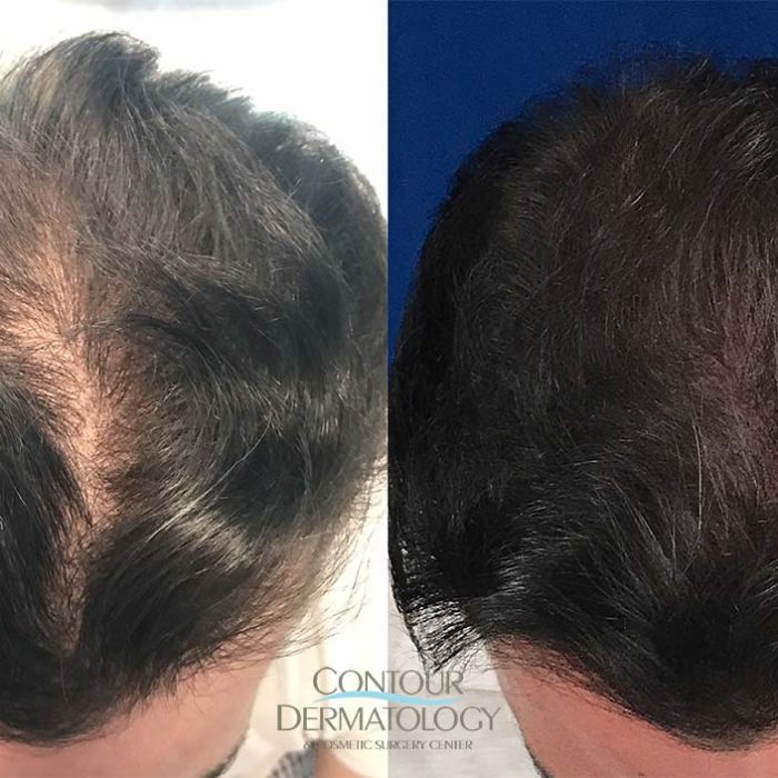 NeoGraft FUE Hair Transplant | Contour Dermatology