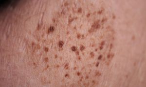 Nevus Spilus | Skin Condition | Contour Dermatology