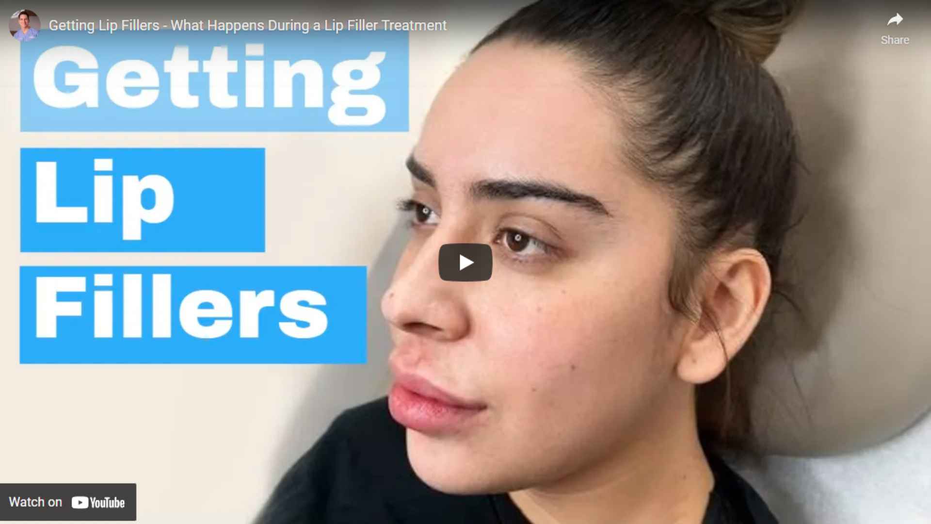 Getting Lip Fillers with Restylane Defyne