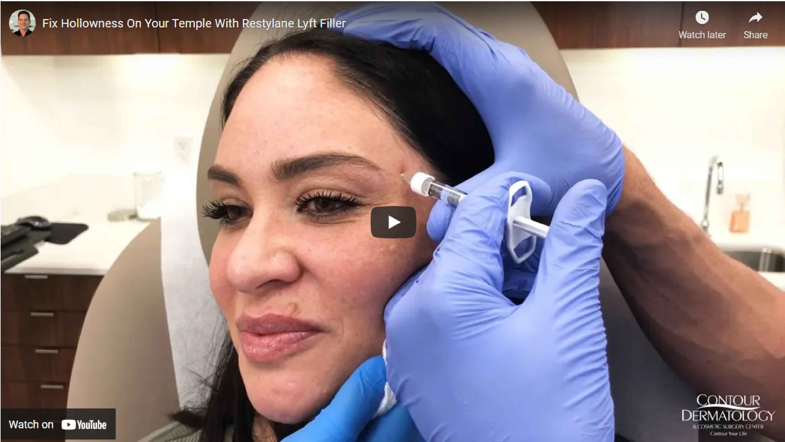 Fix Hollowness On Your Temple with Fillers