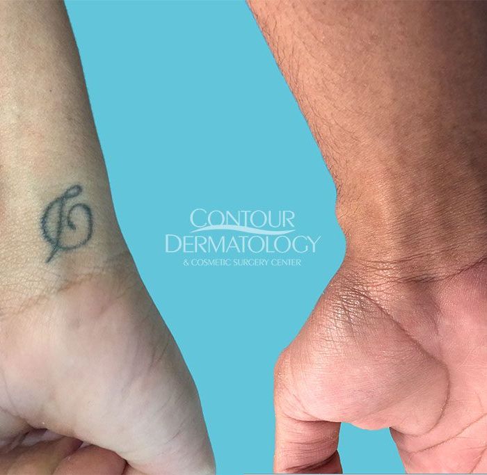 PicoWay Tattoo Removal Before and After Photos